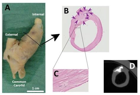 A A Carotid Plaque Sample Obtained From An Endarterectomy Surgery