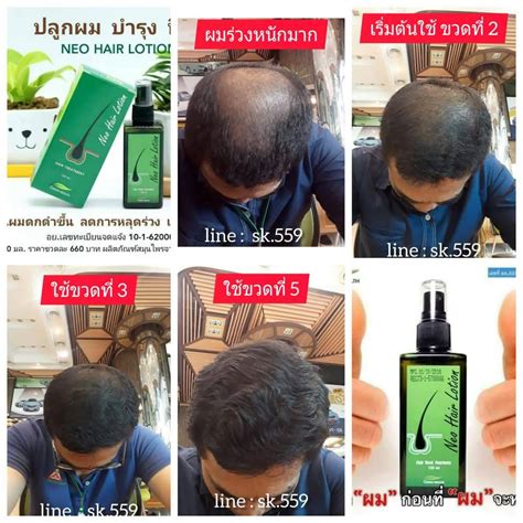 Neo Hair Lotion ผลิตภัณฑ์ดูแล และแก้ปัญหาผมร่วง ผมบาง