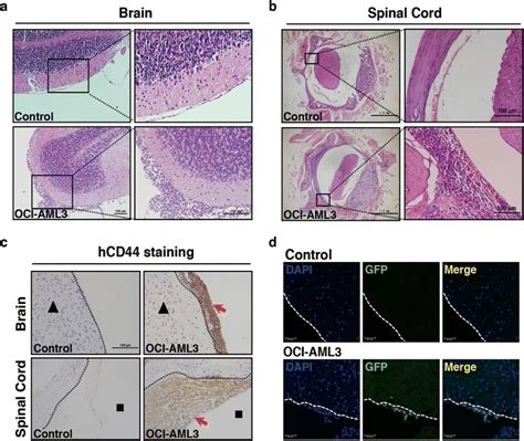 Dnmt3a Mutation Leads To Leukemic Extramedullary Infiltration Mediated By Twist1 Pmc