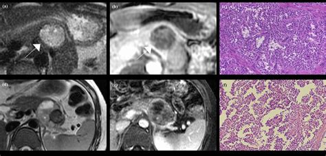 A Patient In Her 10 S With Solid Pseudopapillary Neoplasm Purely Solid Download Scientific