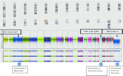 Array Comparative Genomic Hybridisation A Mosaic Gain Of 17q And Loss Download Scientific