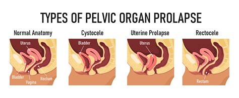 Can A Menstrual Cup Cause Prolapse Understanding Potential Risk