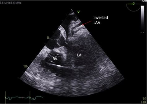 Tee Midesophageal Long Axis View Showing Inverted Laa With Mitral Download Scientific Diagram