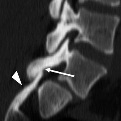 Pdf Isolated Unilateral Facet Dislocation Of The Lumbosacral Junction