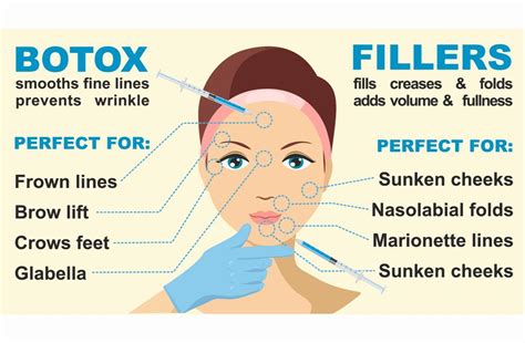 Botox For Marionette Lines Before And After A Comprehensive Guide