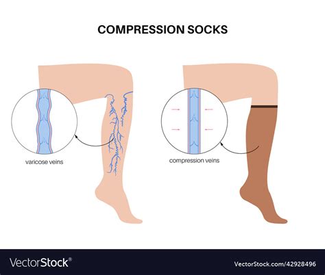 Compression Stocking Pressure Royalty Free Vector Image