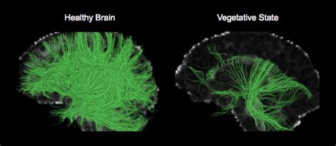 Vegetative State Coma Symptoms Diagnosis Treatment