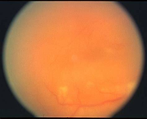 Oftalmološka Poliklinika Dr Balog Vitritis Or Vitreitis