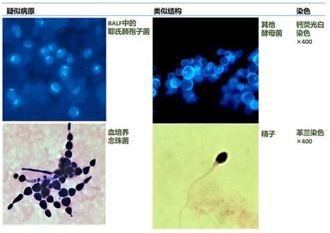 《cmi》发表最新综述：如何使用直接镜检法诊断真菌感染？哪些特殊结构对诊断有重要价值？ 头条 呼吸界