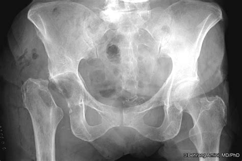 Roentgen Ray Reader Girdlestone Resection Arthroplasty