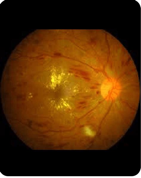 See Clearly A Guide To Common Retinal Diseases View Care