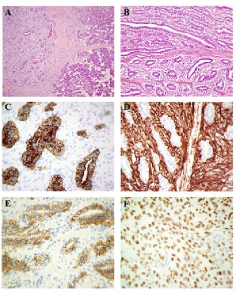 Histology A Normal Parotid Gland Separated From Tumor By A Connective