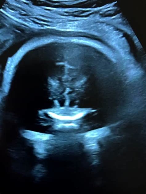 🧠 The Complexity Of Fetal Central Nervous System Cns Development And
