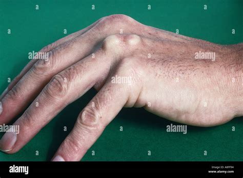 Tendon Xanthomata Rated Medicine