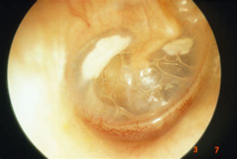 Infected Ear Drum