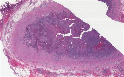 Granulomatous Appendicitis Atlas Of Pathology
