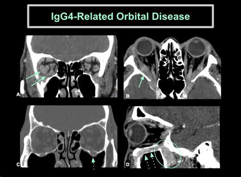 Infraorbital Nerve
