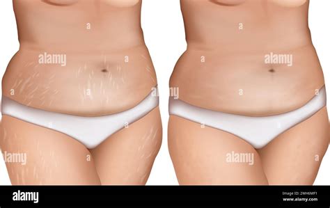 Stretch Marks Also Known As Striae Or Striae Distensae Striae Are