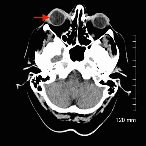 Radiopaedia Case Lens Dislocation Id 52852 Study 58781 Nc Commons