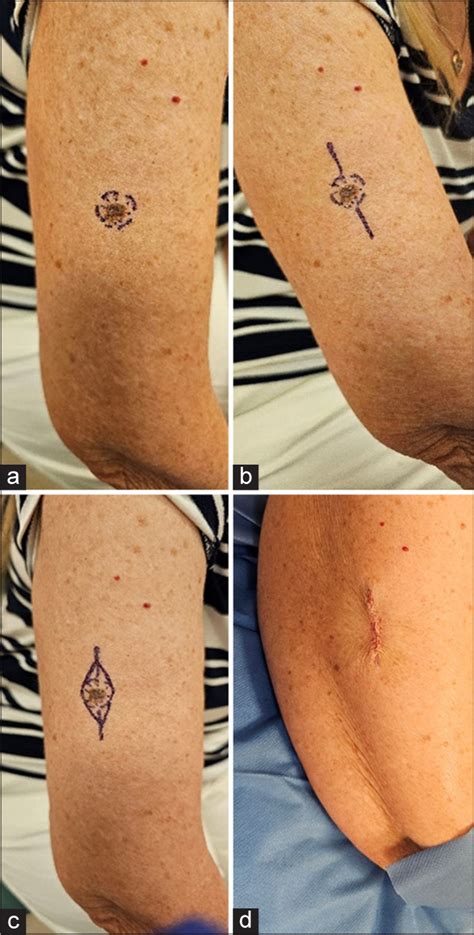 A Residents Guide To Skin Cancer Minor Surgery Jcas