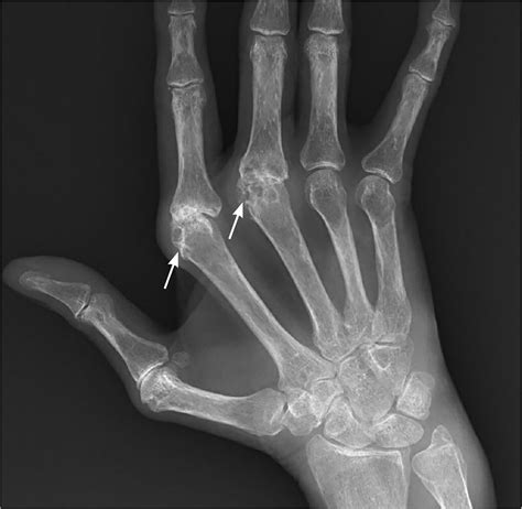 Polyarticular Joint Pain In Adults Evaluation And Differential