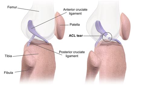 What Is The Difference Between Acl And Meniscus Tear Compare The