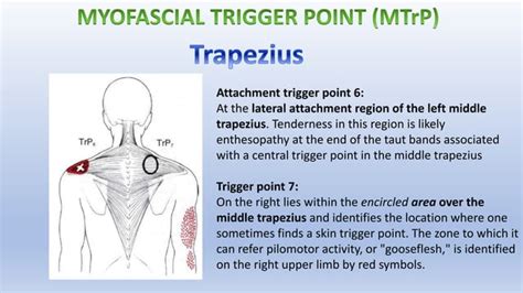 Trigger And Tender Pointspptx First Aid Injuries