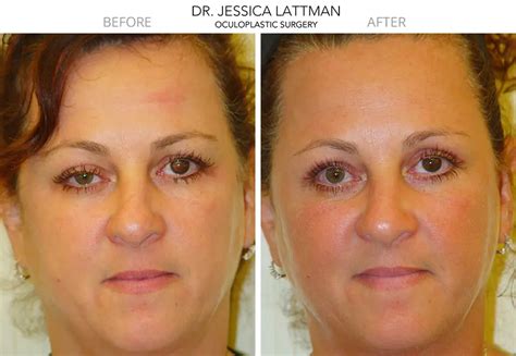 Droopy Eyelid From Botox How And Why It Happens Maylips