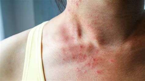 Skin Rash Crohns Disease Symptoms