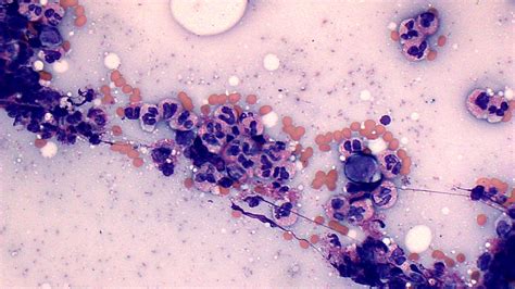 Lymph Node Eclinpath