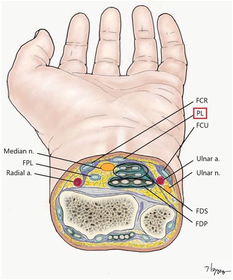 A Pilot Study Of 17 Wrist Cutting Suicide Injuries In Single