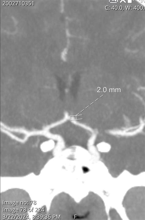 Say Hello To My Brain Aneurysm 😂 R Brainaneurysm