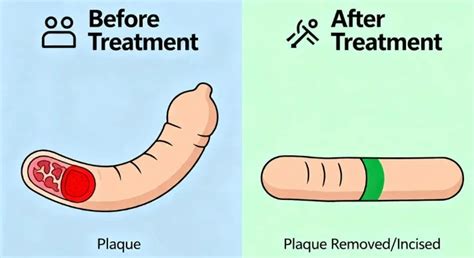 Peyronies Disease Or Curved Penis Symptoms And Treatment