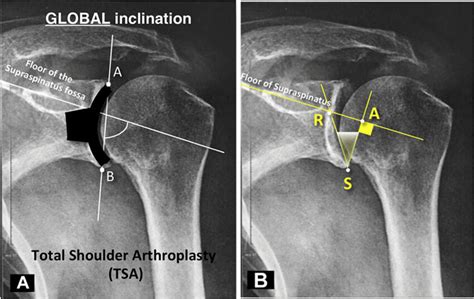 Traditional β Angle Measurement A Versus Reverse Shoulder Download Scientific Diagram
