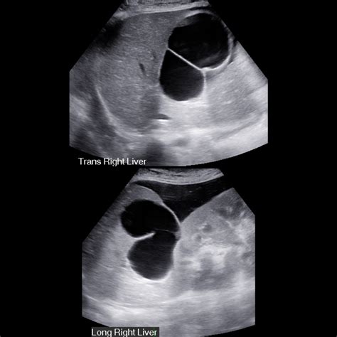 Pediatric Gallbladder Hydrops Pediatric Radiology Reference Article Pediatric Imaging