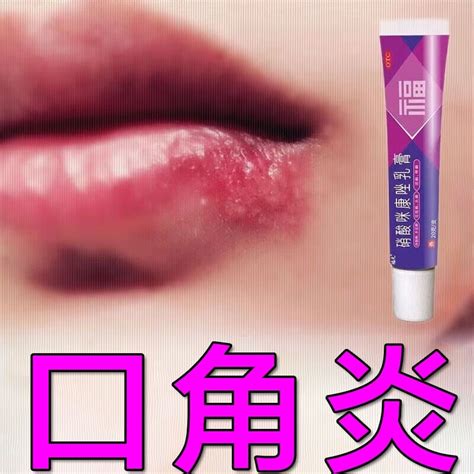 Angular Stomatitis Ointment Miconazole Nitrate Emulsifiable Paste Mouth Getting Angry Sparkling