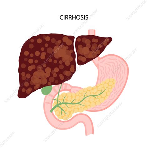 Liver Disease Illustration Stock Image F0361505 Science Photo