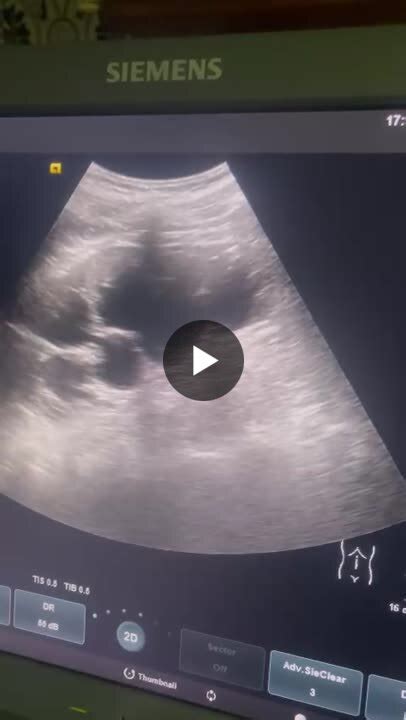 🎥 Incidental Finding Grade 3 Hydronephrosis On Ultrasound
