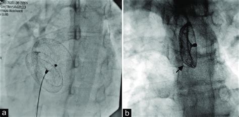 A Fluoroscopic View Of Asd Occluder Amplatzer Device Placed Download Scientific Diagram