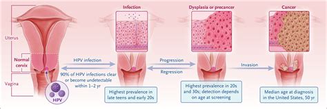 Can Human Papillomavirus Hpv Cause Pain During Sex The Pelvic People