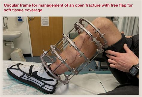 Open Fractures Surgery Oxford International Edition