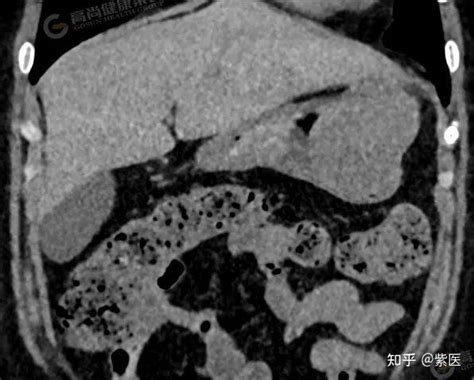 54岁女性，体检发现胃部间质瘤 知乎