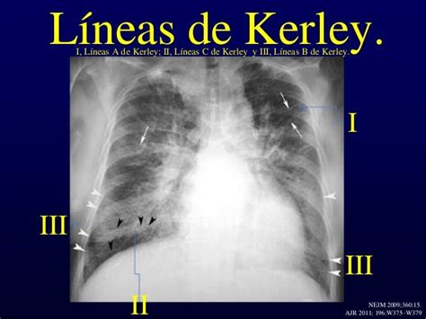 Arbpce 2014 Lineas De Kerley