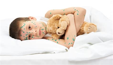 Despre Varicela Simptome Complicatii Si Vaccin Prim Ajutor