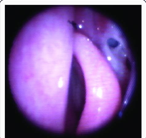Left Sided Maxillary Antrum Download Scientific Diagram