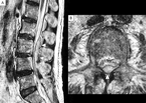Spinal Epidural Abscess A Review Highlighting Early Diagnosis And