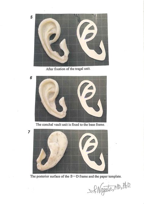 Auricular Reconstruction Nagata Method｜nagata Microtia And