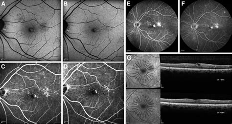 Fundus Autofluorescence Photography Of The Left Eye With Fidme And