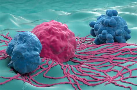 Thyroid Cancer Illustration Stock Image F0405913 Science Photo