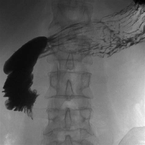 Four Cm Long Complete Rupture Of The Anterior Wall Of The Duodenum